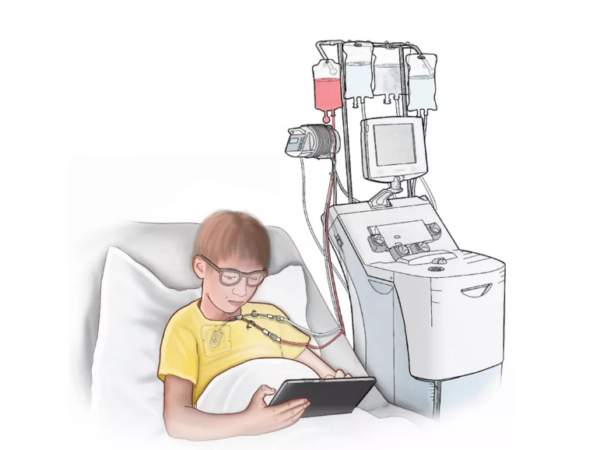 What is Leukapheresis? - Mobil Dialysis